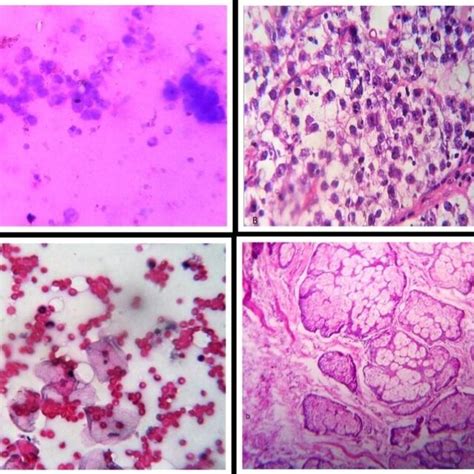 A Imprint Cytology Of Dysgerminoma 100x B Histology Of Ovarian Download Scientific Diagram