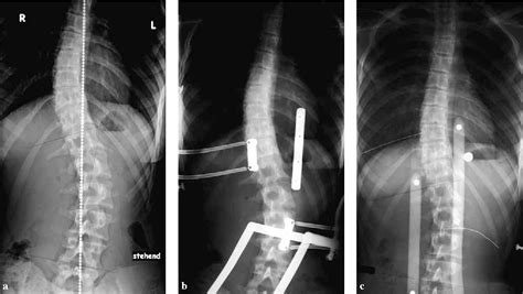 Figure 1 From The Flexible Triac Brace For Conservative Treatment Of Idiopathic Scoliosis An