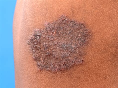 Tinea Imbricata Tinea Life Worldwide