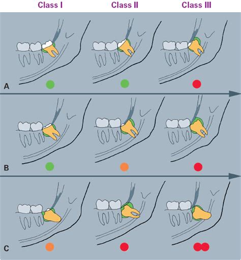 8 The Mesially Inclined Third Molar Pocket Dentistry