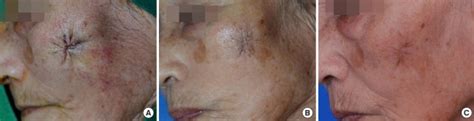 Surgical Refinement Of The Purse String Suture For Skin And Soft Tissue