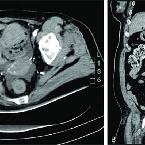 A B Plain Computed Tomography Showed Hyperdense Lesion In The