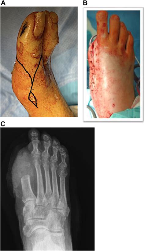 Approach To Partial Foot Amputations Clinics In Podiatric Medicine