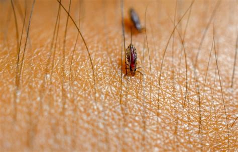 Pediculoza Simptome Si Remedii