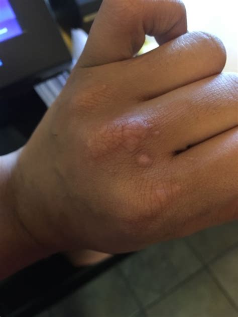 Itchy Red Bumps On Knuckles Glow Community