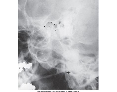 Axiolateral Schuller Tmj Mouth Closed — Printable Worksheet