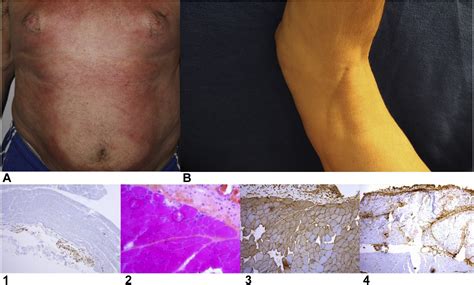 Eosinophilic Fasciitis And Common Variable Immunodeficiency An Unusual Association And