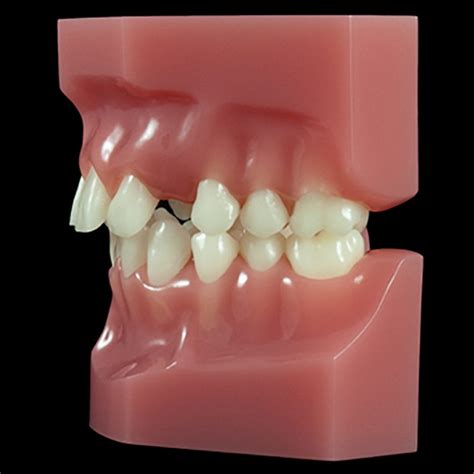 Or 17m Mixed Dentition Class Ii Division 1 Blocked Cuspid Flexibase