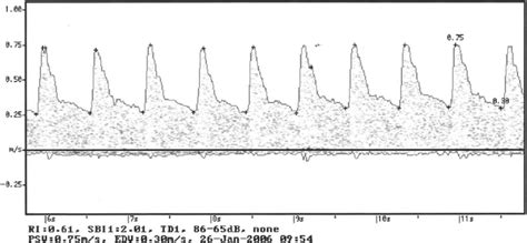 Left Cavernosal Artery Following 25 Mcg Alprostadil Ici And