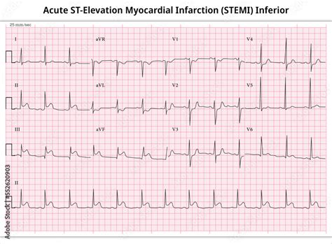 Acute St Elevation Myocardial Infarction Stemi Inferior Ecg Paper 12 Lead Stock Vector