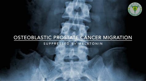 Osteoblastic Prostate Cancer Migration Suppressed By Melatonin Videoabstract Science Research