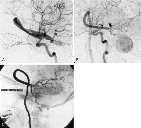 Ec Ic And Ic Ic Bypass For Giant Aneurysms Using The Elana Technique Neupsy Key