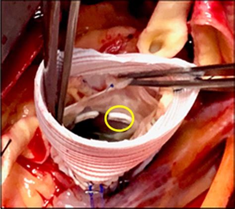 Evolution Over… The American Association For Thoracic Surgery Aats