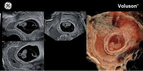 First Trimester Bleeding What Ivf Specialists Need To Know Empowered