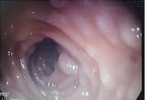 Diffuse Nodules In The Duodenum Download Scientific Diagram