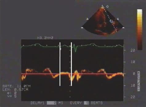 Measurement Of Inter Atrial Conduction Time Download Scientific Diagram