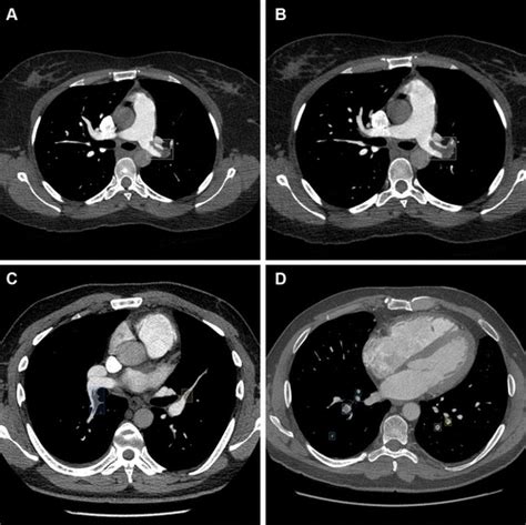 Augmentation Of The Rsna Pulmonary Embolism Ct Dataset With Bounding Box Annotations And