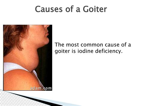 Goiter Causes And Prevention Types Of Goiters Rerlct