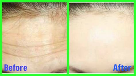 How To Remove Wrinkles From Face And Forehead Naturally Home Remedy
