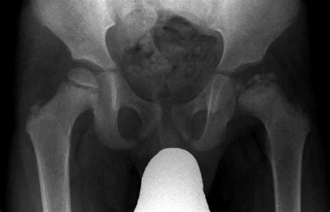 Necrose Avascular Secundária Não Traumática — Sintomas Genes