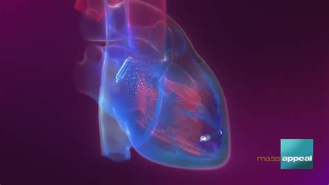 Pacemaker Innovation With Abbott Wwlp