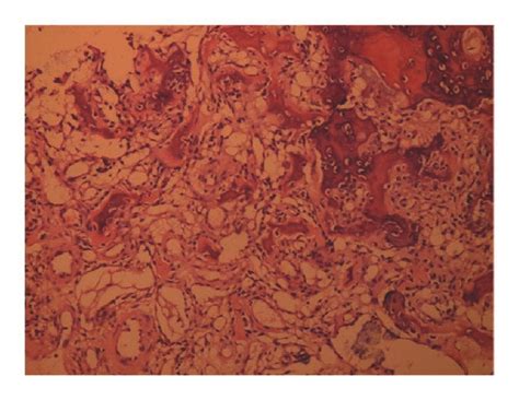 Photomicrograph Of The Lesion Revealing Abundant Osteoid Formation