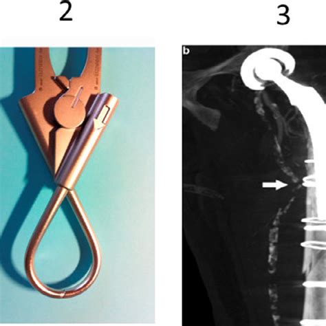 Cerclage Placement 1 Cable Passer Hook 2 Minimally Invasive