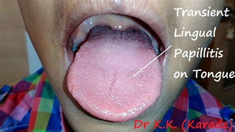 Transient Lingual Papillitis