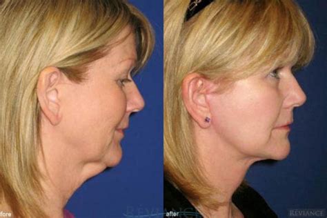 Facelift In Portland And Clackamas Or Réviance® Plastic Surgery