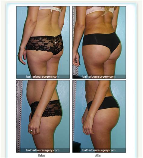 Buttocks Augmentation Plastic Surgery Level 6 Website