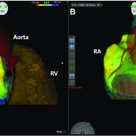 Activation Map Of Sinus Rhythm Merged With Cardiac Computed Tomography