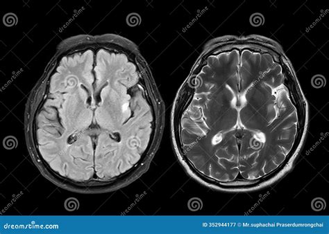 Mri Brain Scan Axial T1w For Detect Brain Diseases Sush As Stroke