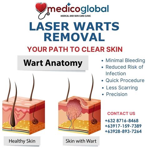 Genital Warts Removal At Medico Global Clinic Manila Taguig And Qc