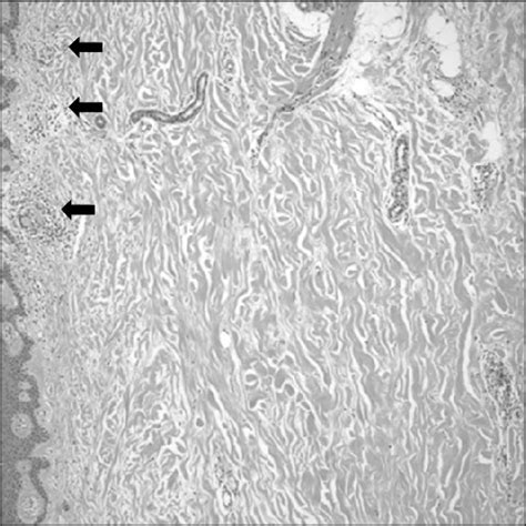 Neck Ct Shows Multiple Lymph Node Enlargement White Arrows