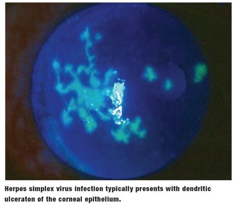 Herpes Zoster Ophthalmicus Cornea
