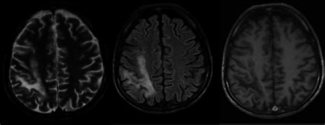 Brain Mri In The Axial Plane Depicting A Hyperintense Right