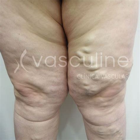 Flebitis En Las Extremidades Causas Síntomas Y Soluciones