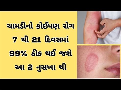 Dhadhar Skin Problem Solution In Gujarati Kharajvu No Ilaj Youtube