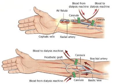 Assessing Maturity Of A Fistula