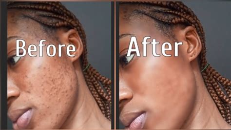 Skin Retouching Remove Acne And Pimples Using Photoshop Youtube