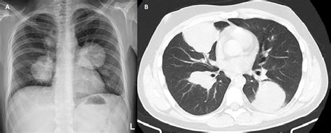 Waxing And Waning Pulmonary Opacities Radiology At Rory Barbour Blog