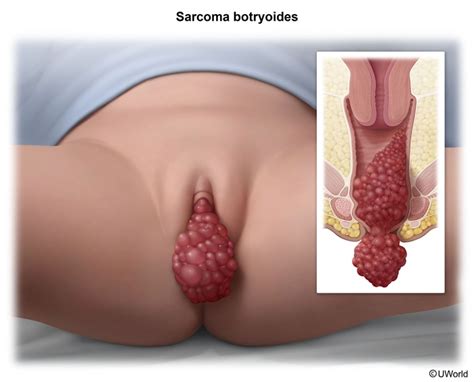Sarcoma Botryoides Gynecology Uworld Medical Library