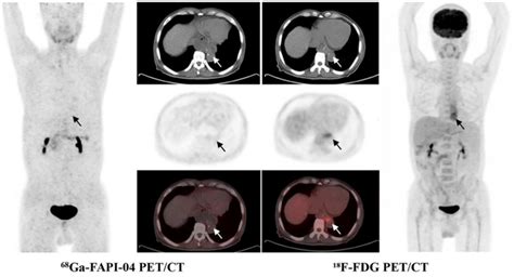 Fapi Fdg Recurrence A 67 Year Old Male Patient Id 28 With Download Scientific Diagram