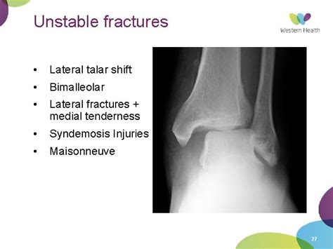 Ankle Fractures Phong Tran Orthopaedic Surgeon Western Health