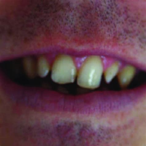 Normal Relationship Between Condyle And Disc They Move Together Download Scientific Diagram