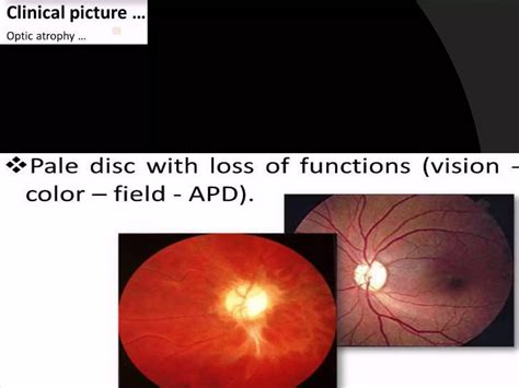 Optic Nerve Optic Atrophy Clinical Round Ppt