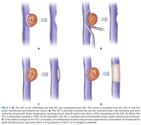 Vena Cava Resection During Hepatectomy Abdominal Key