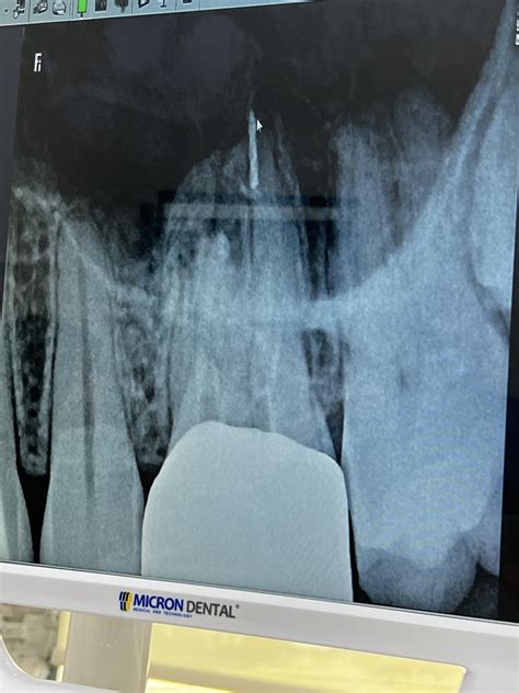 Failed Root Canal Rrootcanal