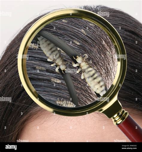 Pediculosis Woman With Lice And Nits Closeup View Through Magnifying