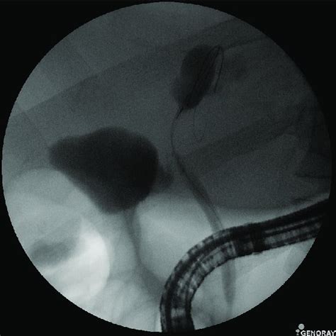 Fluoroscopic Evaluation Of An Indeterminate Biliary Stricture In The